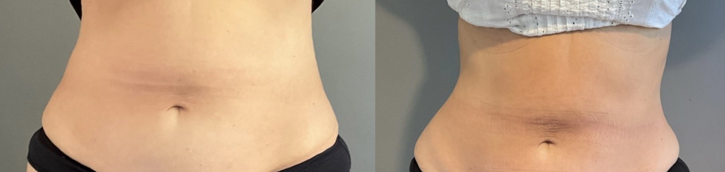 The Hour Glass - 3D Body Contouring